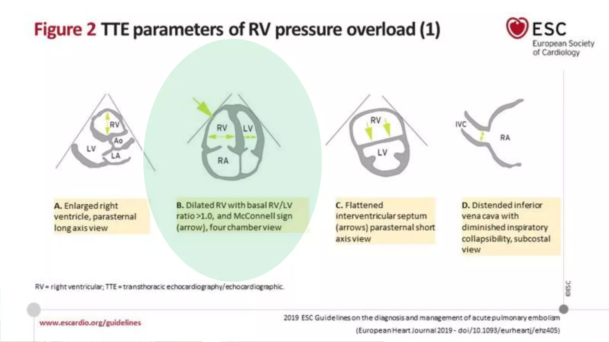 Diagnostic Algorithm for Acute Pulmonary Embolism.pptx