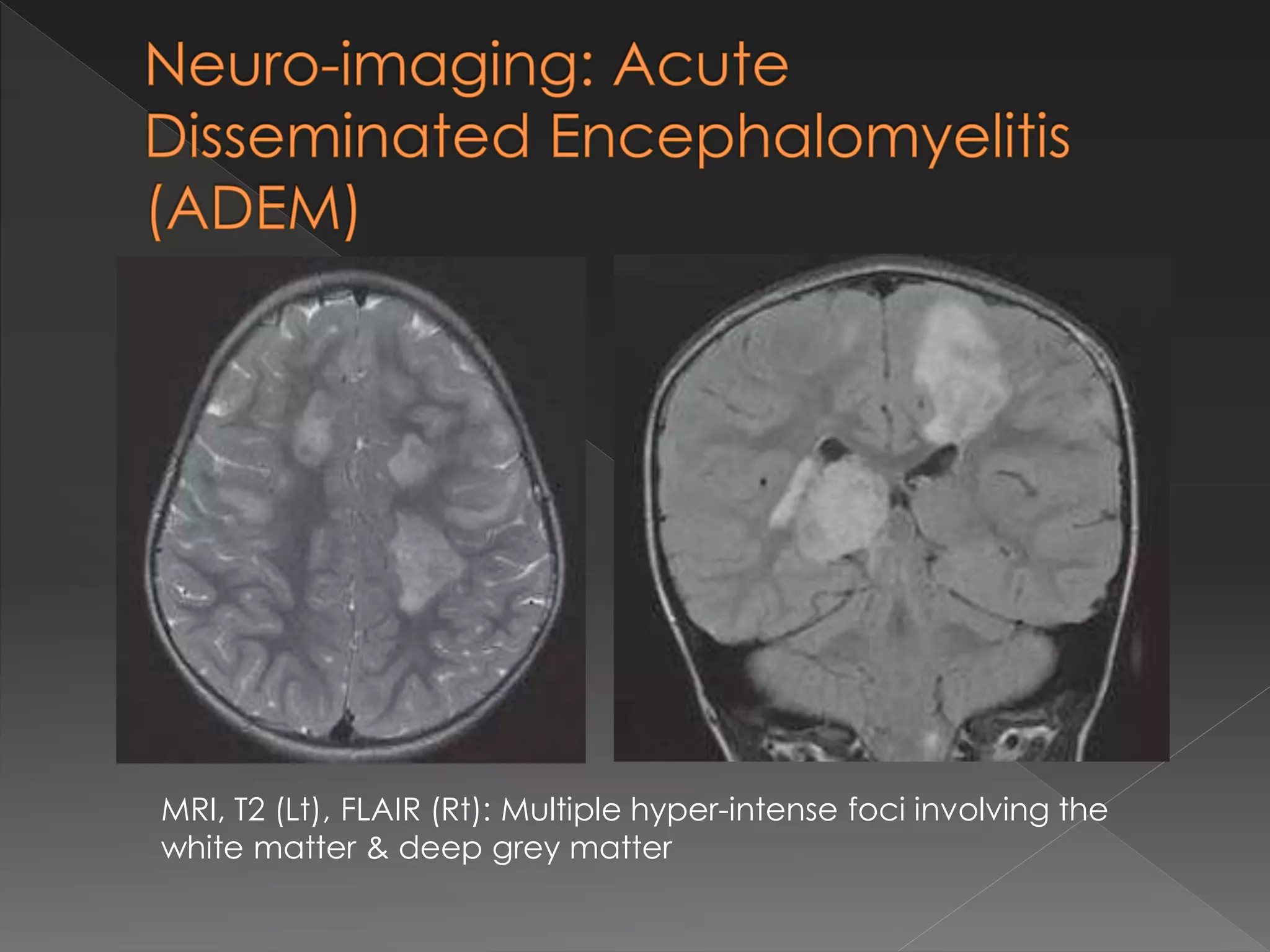 Diagnostic approach to acute encephalopathy | PPT