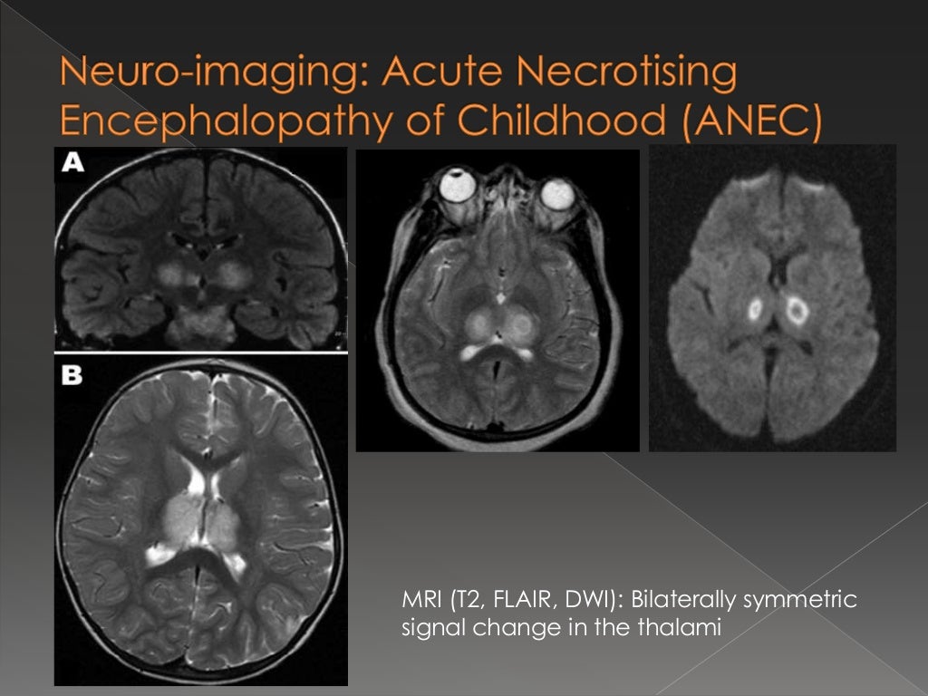 Diagnostic approach to acute encephalopathy