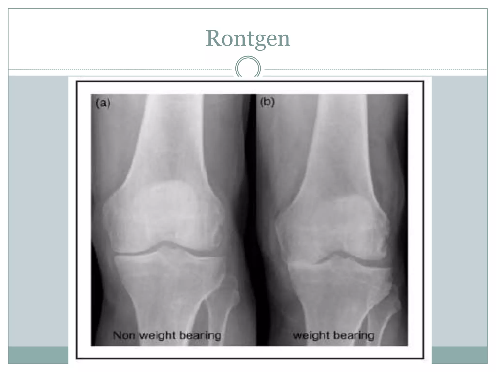 Diagnostic approach to knee joint effusion | PPTX