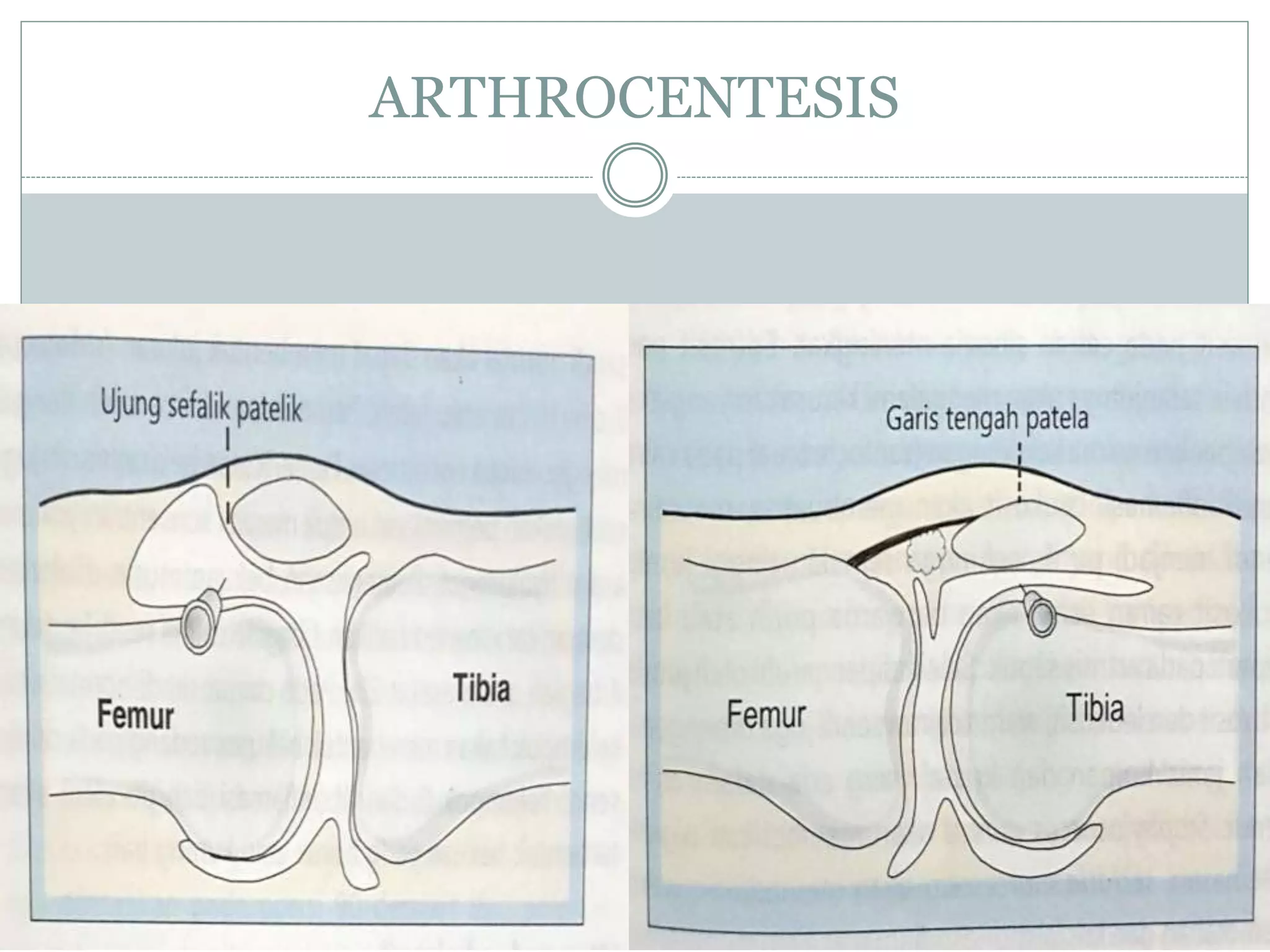 Diagnostic approach to knee joint effusion | PPTX