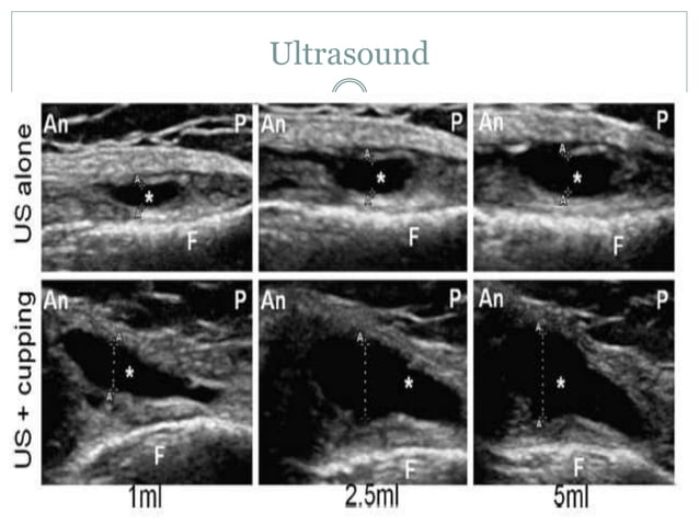 Diagnostic approach to knee joint effusion | PPTX