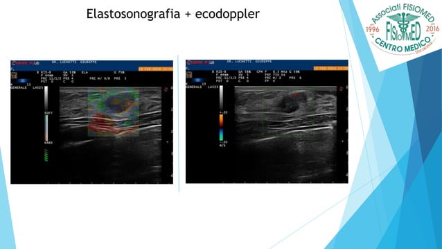 Diagnostica senologica ecografia mammaria - dr.giuseppe luchetti ...
