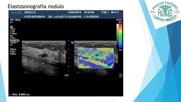 Diagnostica senologica ecografia mammaria - dr.giuseppe luchetti ...