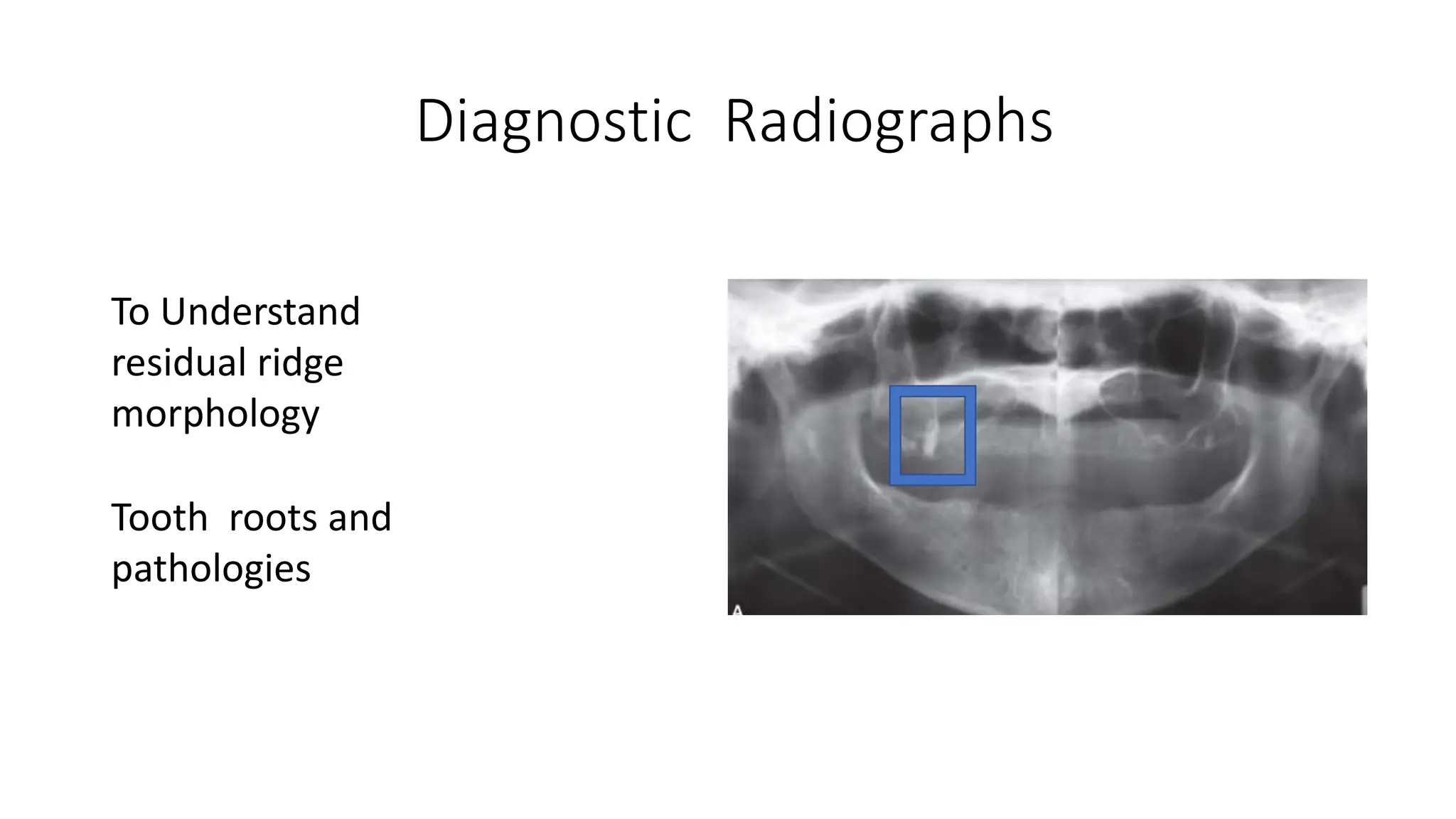 Diagnostic cast FOR COMPLETE DENTURES pptx | PPTX