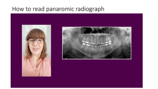 Diagnostic cast FOR COMPLETE DENTURES pptx | PPTX