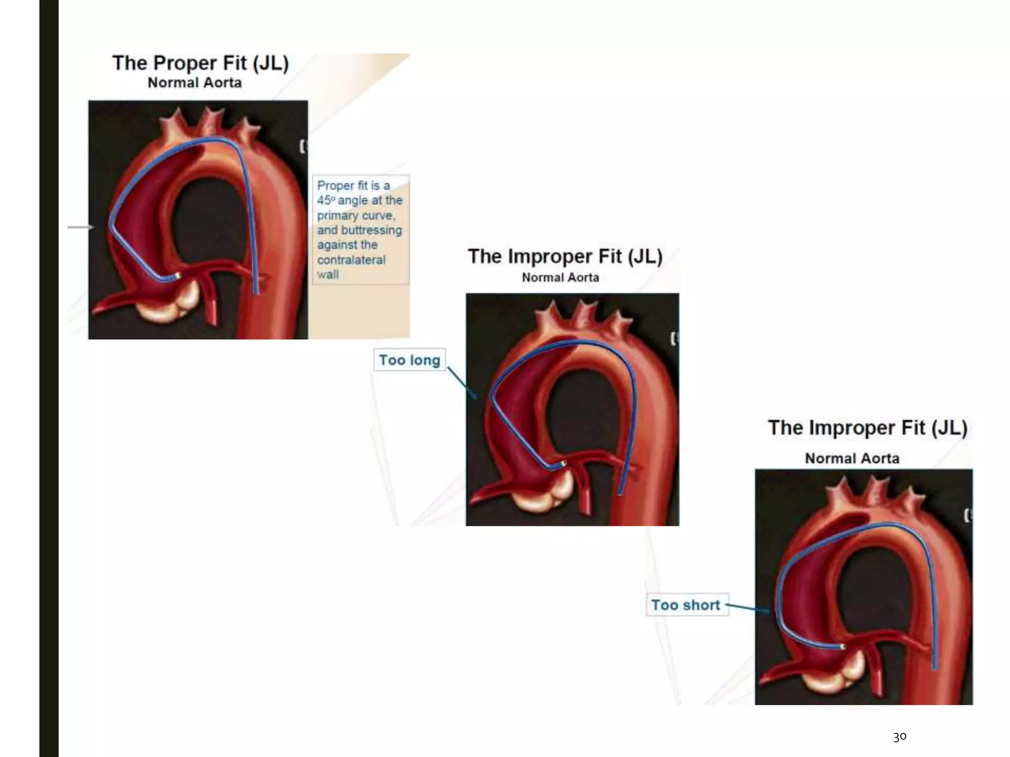 Diagnostic catheters for coronary angiography | PPTX