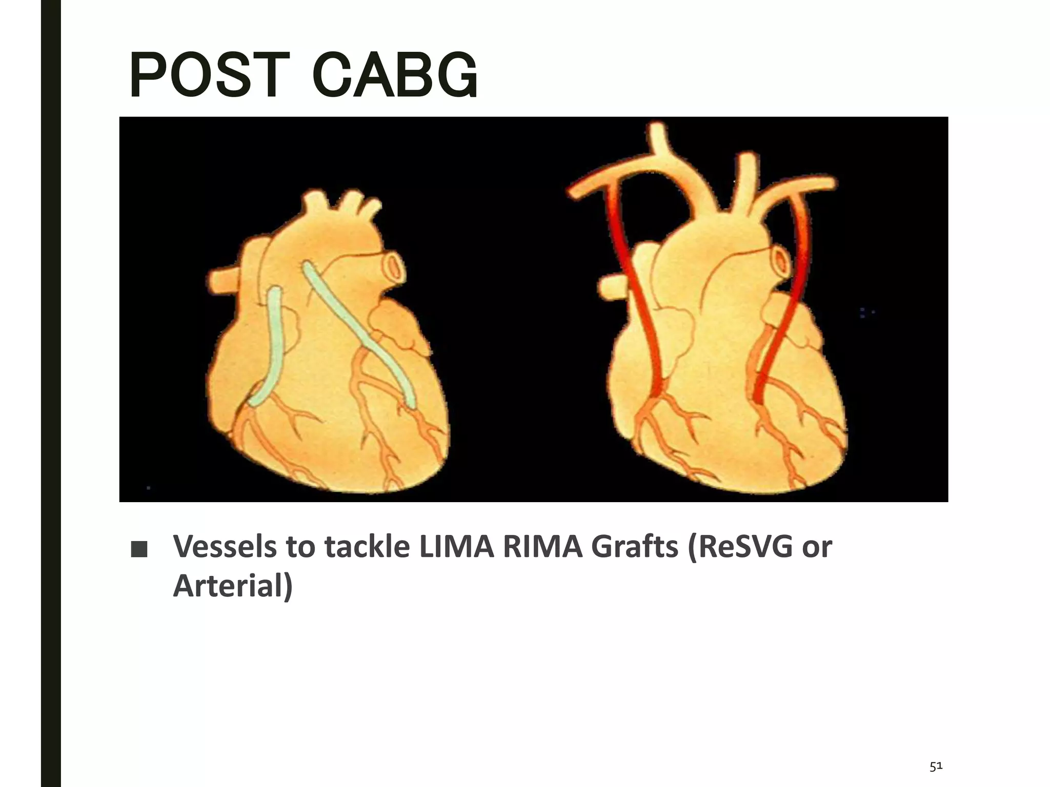Diagnostic catheters for coronary angiography | PPTX