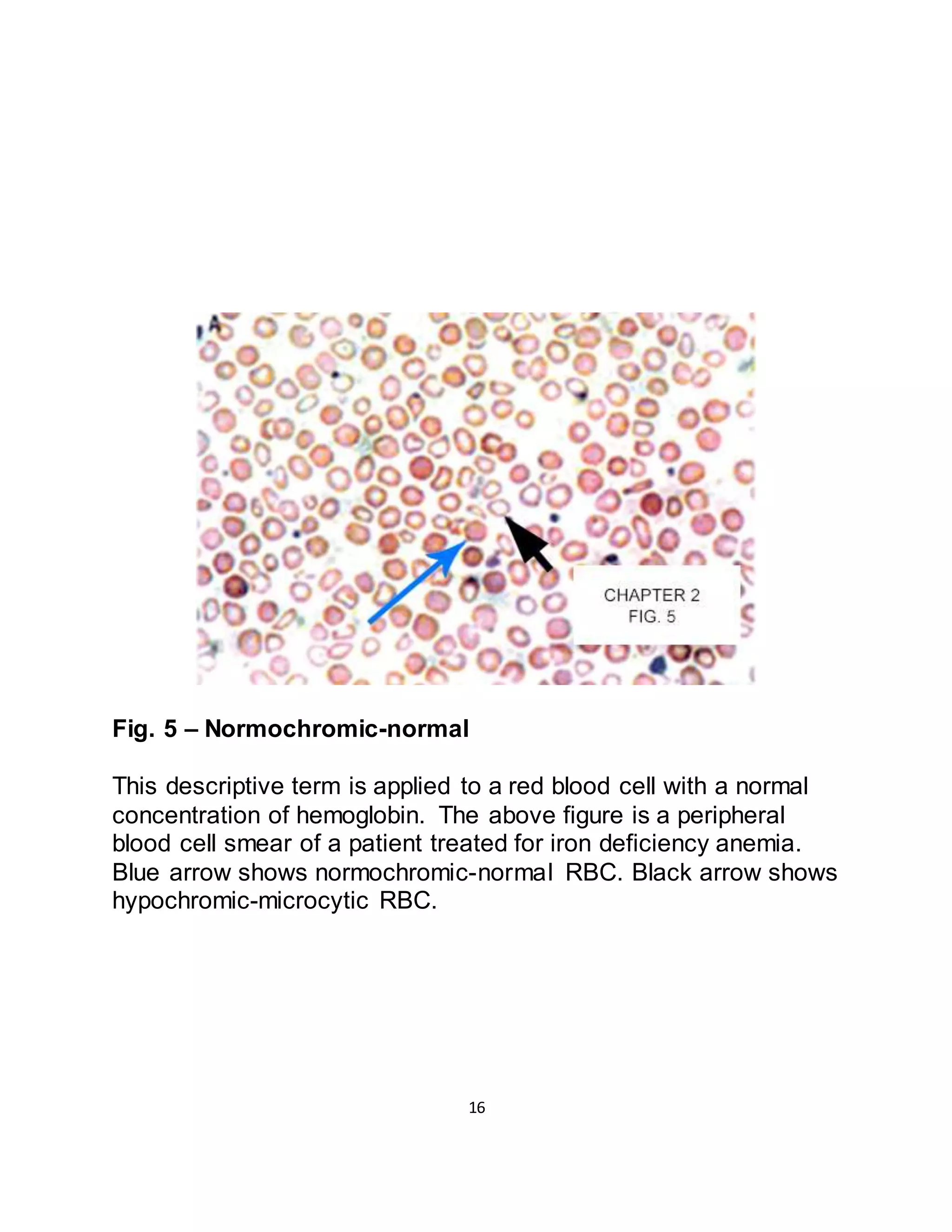 Diagnostic hemoglobinopathies Second Edition | DOCX | Blood Disorders ...