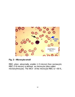 Diagnostic hemoglobinopathies Second Edition | DOCX | Blood Disorders ...