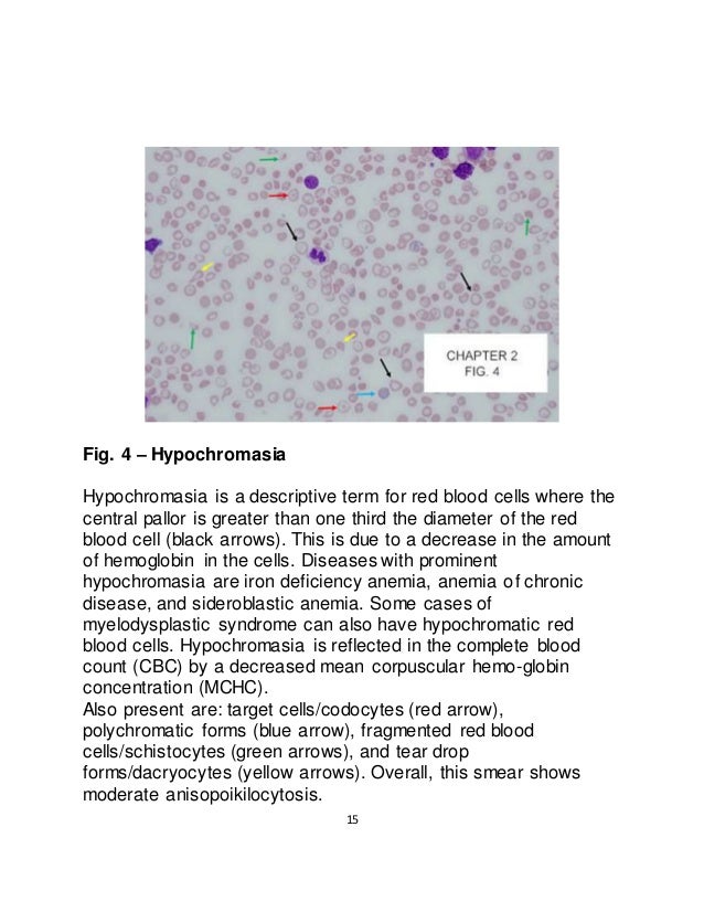 Diagnostic Hemoglobinopathies Second Edition