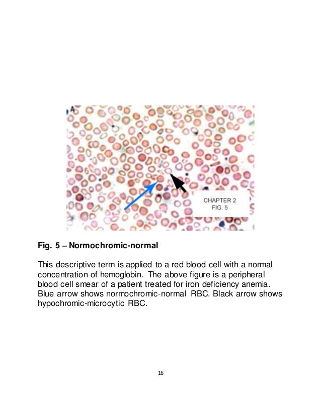 Diagnostic Hemoglobinopathies Second Edition