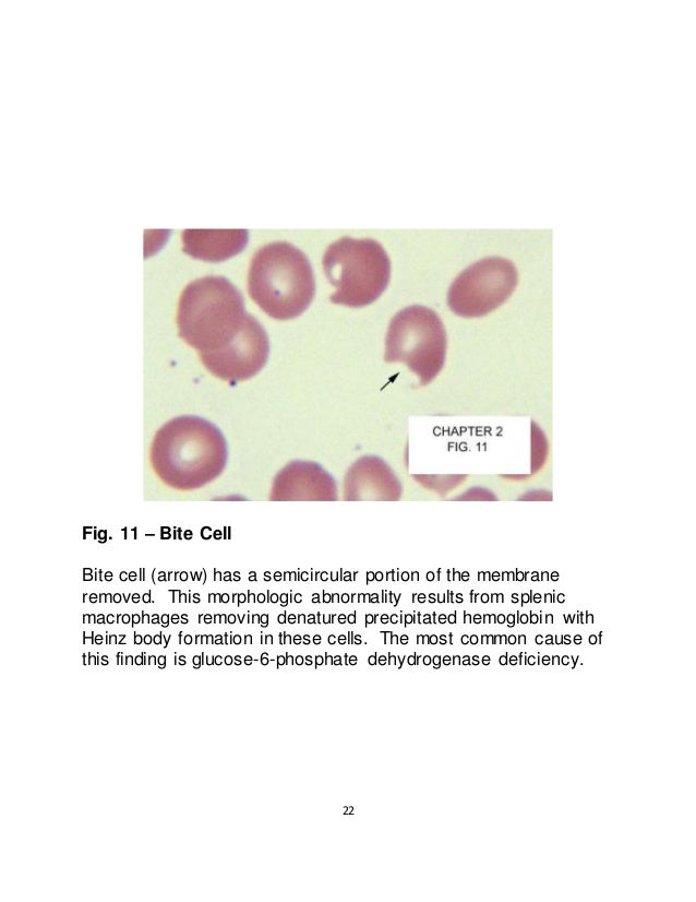 Diagnostic Hemoglobinopathies Second Edition