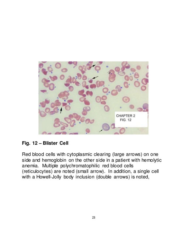 Diagnostic Hemoglobinopathies Second Edition