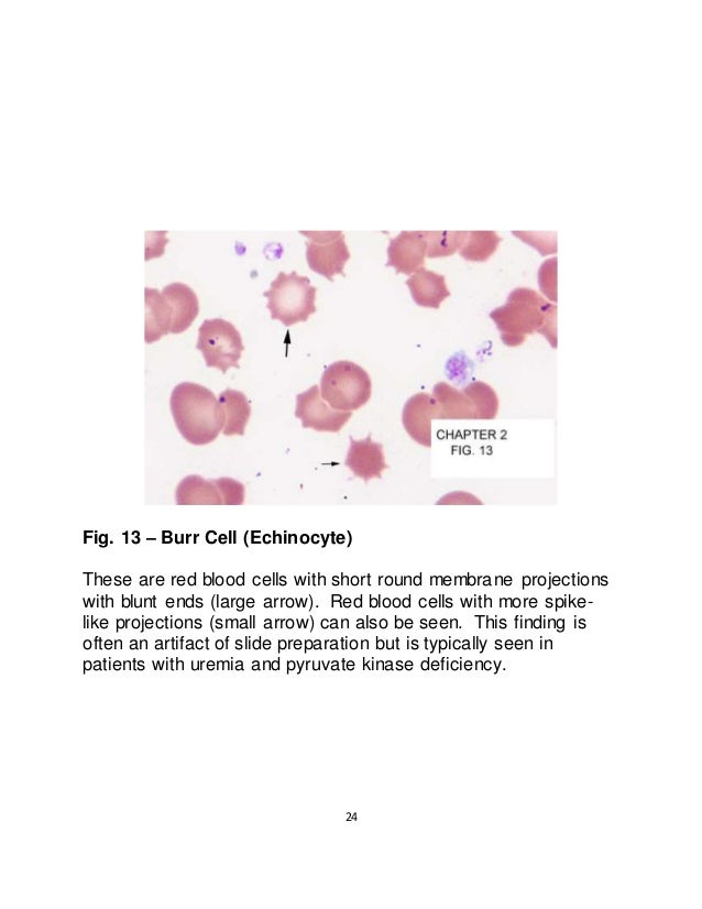 Diagnostic Hemoglobinopathies Second Edition
