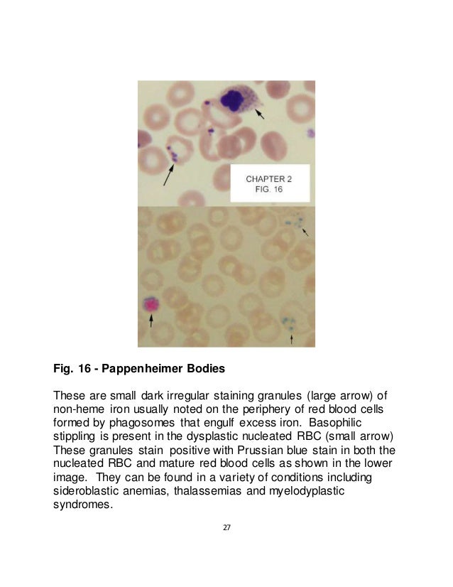 Diagnostic Hemoglobinopathies Second Edition