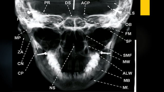 Diagnostic Imaging in Oral and Maxillofacial Surgery | PDF | Bone and ...