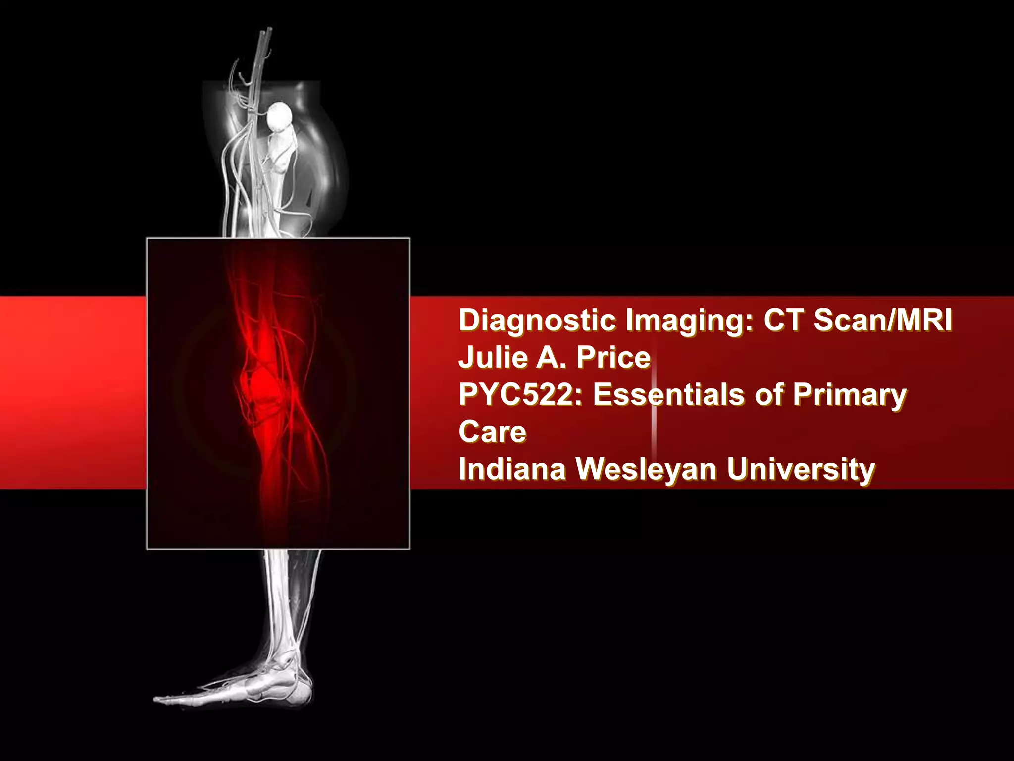 Diagnostic imaging in acl tear | PPTX