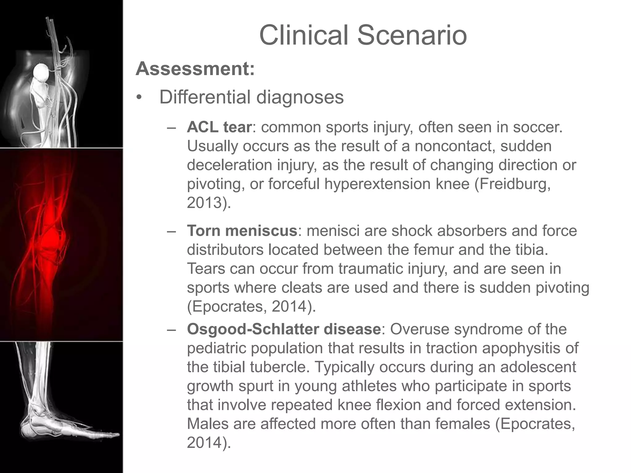 Diagnostic imaging in acl tear | PPTX