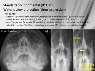diagnosticimaginginoromaxillofacialsurgery-141214161540-conversion ...