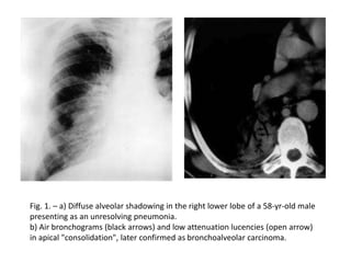 Diagnostic imaging of lung cancer | PPTX