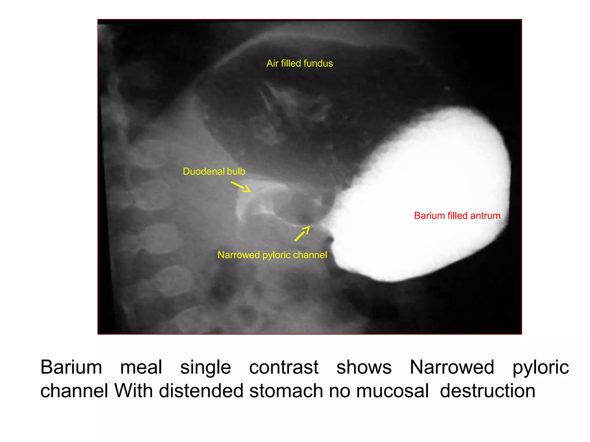 Diagnostic modalities for Gastric diseases.pptx