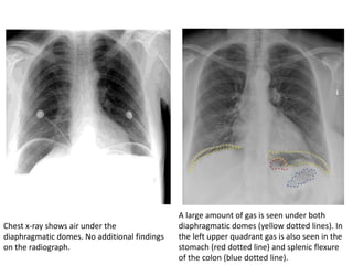 Diagnostic modalities for Gastric diseases.pptx