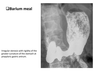 Diagnostic modalities for Gastric diseases.pptx