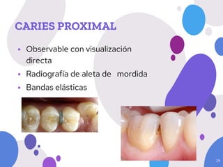 Diagnóstico de caries akkwkwkdknkdkmfndkd | PDF