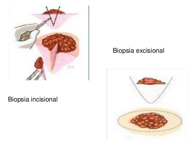Diagnostico de laboratorio del cáncer