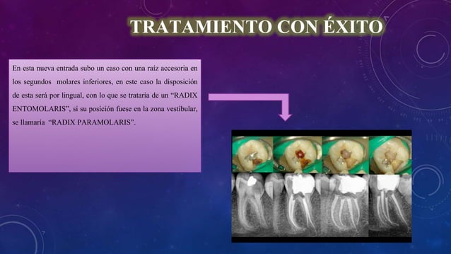 Diagnostico de lesiones pulpares y periapicales | PPT