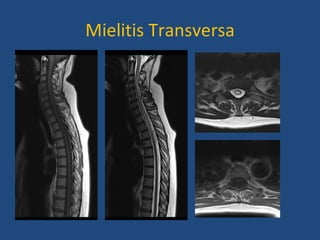 Diagnostico Lesiones Medulares | PPT