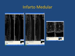 Diagnostico Lesiones Medulares | PPT