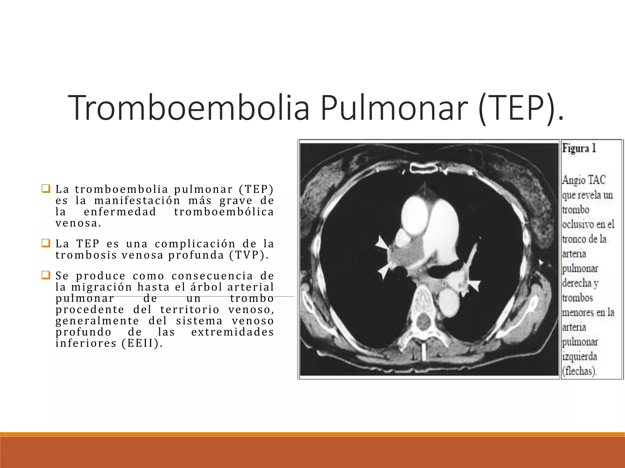 tromboempolismo pulmonar | PPTX