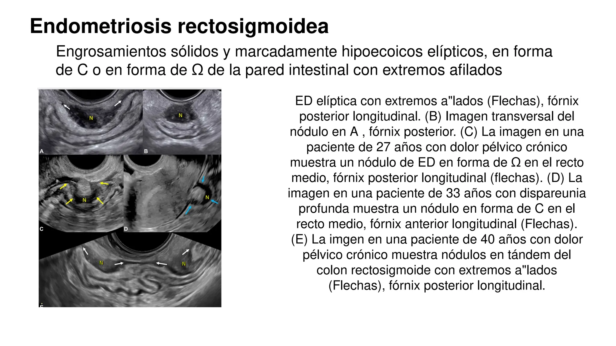 Diagnóstico imagenológico de la endometriosis.pptx
