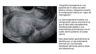 Diagnóstico imagenológico de la endometriosis.pptx