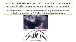 Diagnóstico imagenológico de la endometriosis.pptx