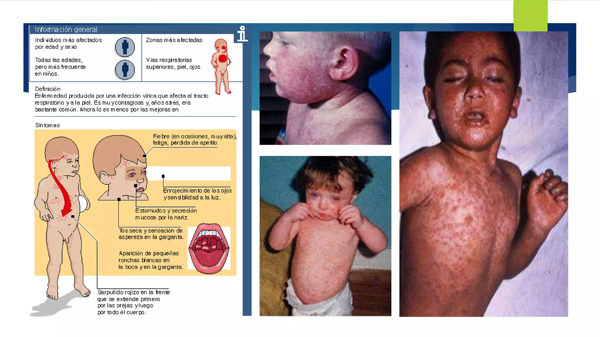 Diagnostico inmunoserologico de rubeola adquirida | PPTX