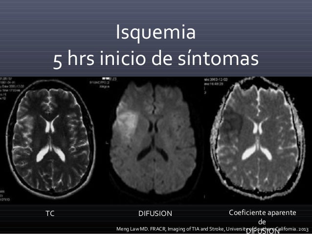 Isquemia Cerebral