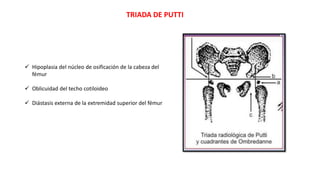 Diagnostico precoz de la displasia de cadera | PPTX