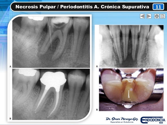 Diagnostico pulpar y_periapical