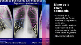 Diagnostico Rx enf Pulmonar difusa Parte I.pdf