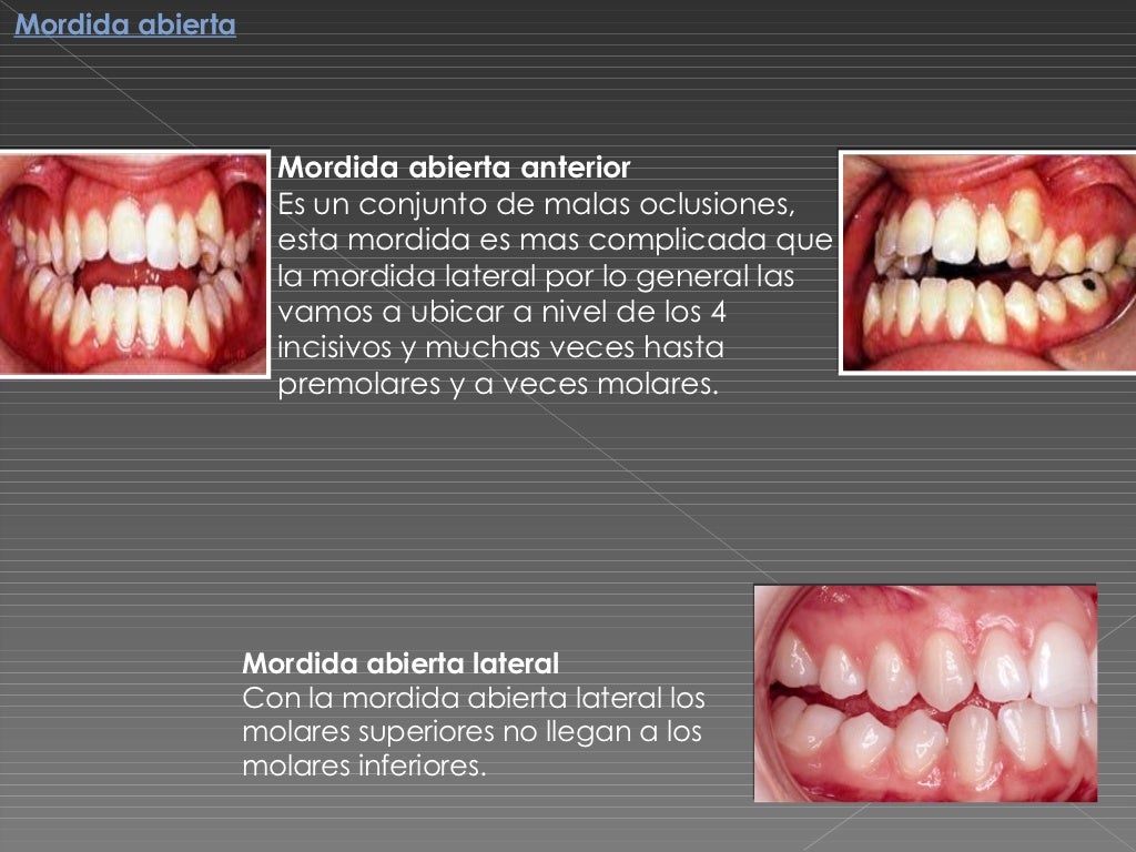 Diagnóstico -Tipos de Mordida