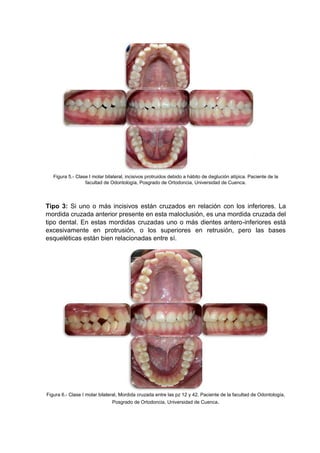 Diagnostico y plan de tratamiento de las maloclusiones | PDF