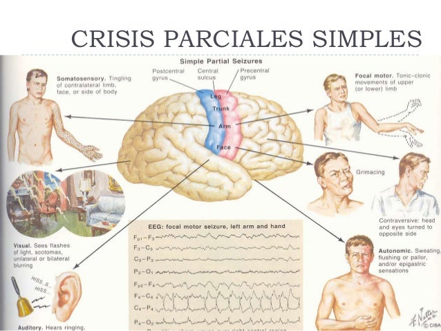 Diagnostico y tratamiento de la primera crisis convulsiva