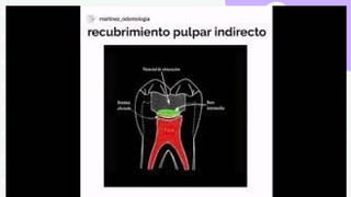 Comprehensive Guide to Pulp Vitality Tests and Pediatric Pulp Therapy ...