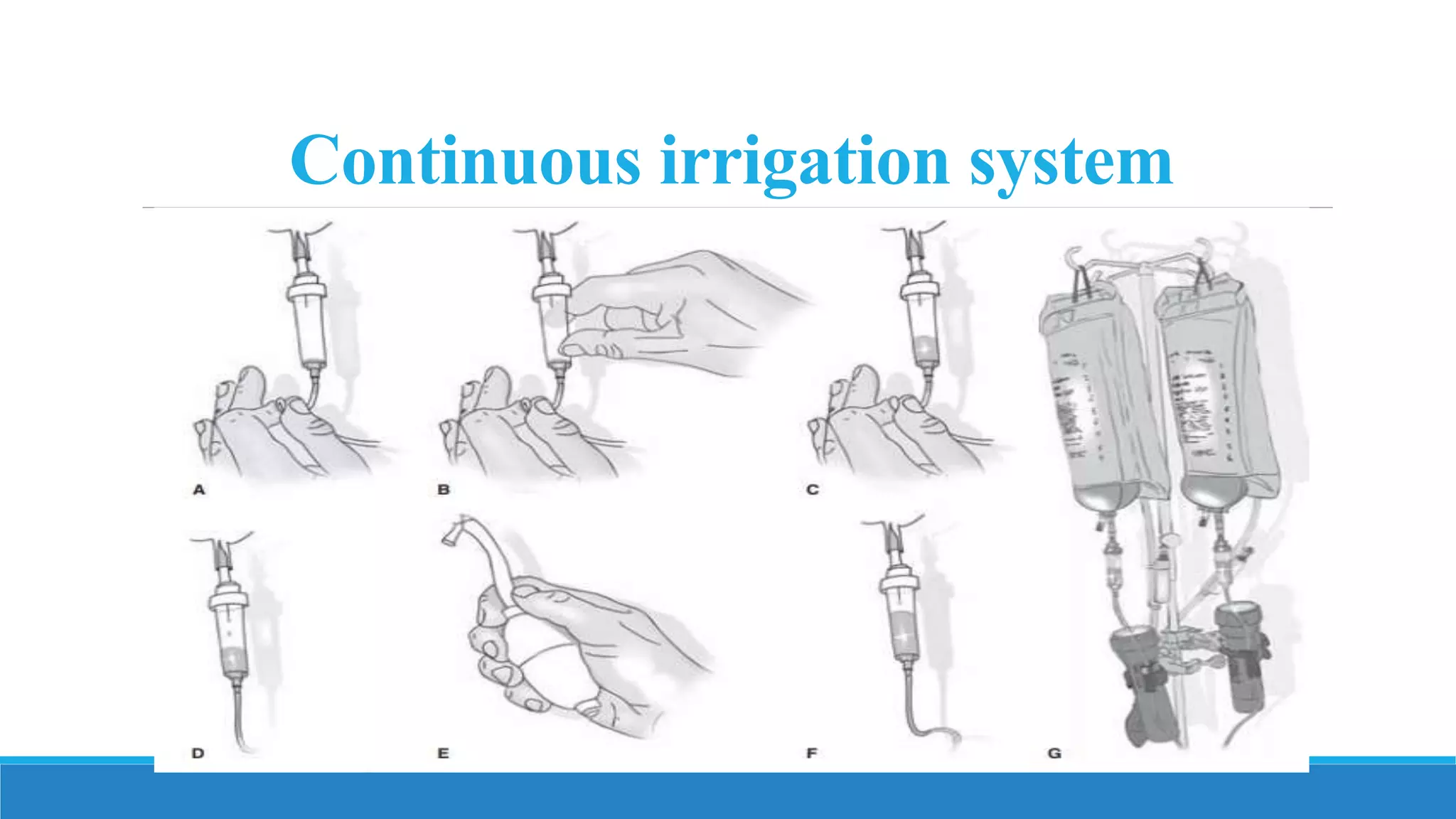 Diagnostic procedure of dsa and management of its | PPTX