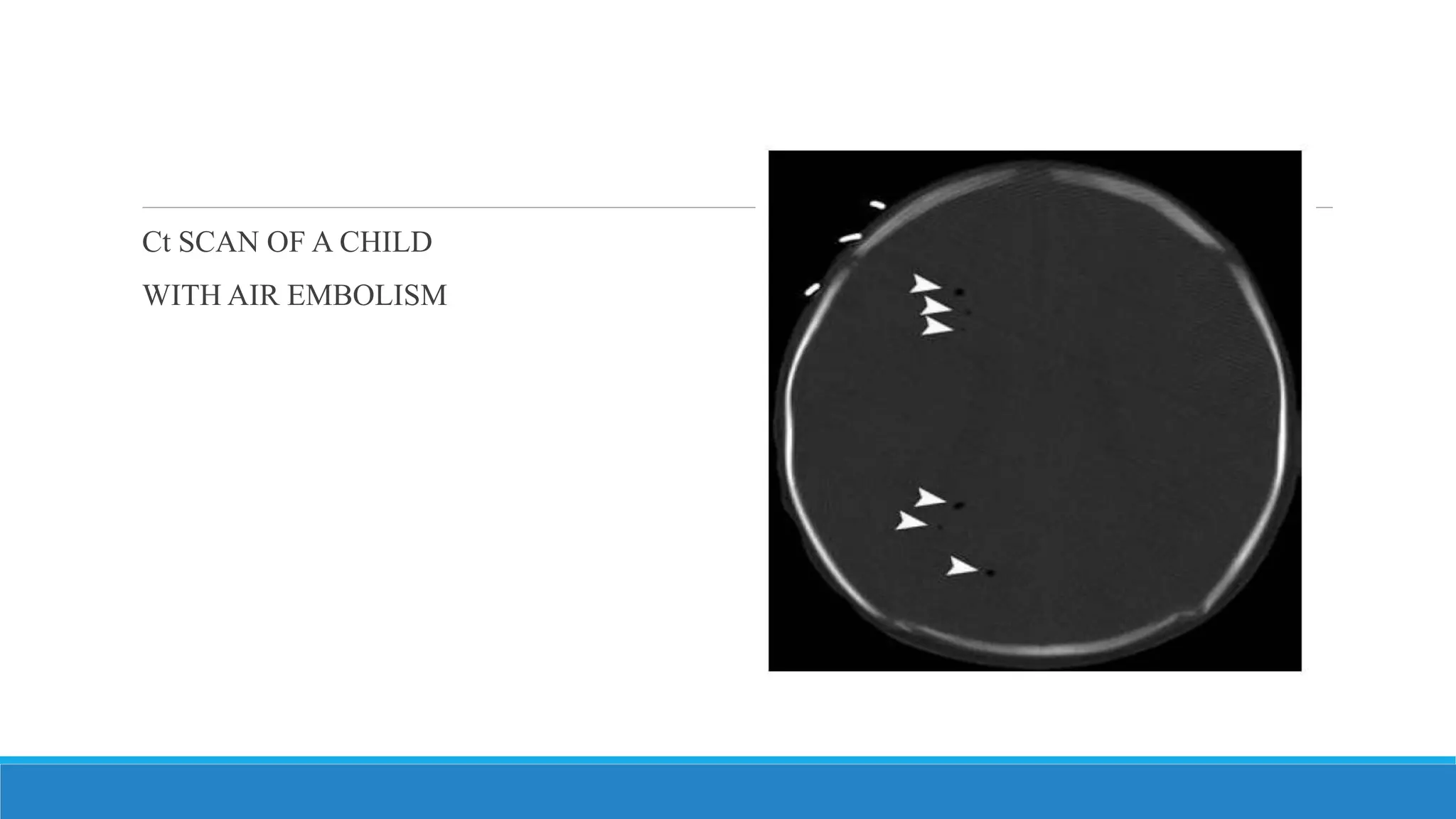 Diagnostic procedure of dsa and management of its | PPTX