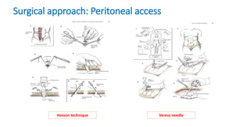 Diagnostic Staging Laparoscopy | PPT