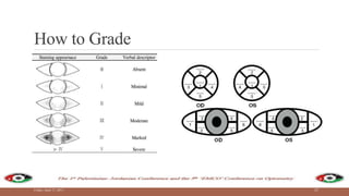 Diagnostic techniques of dry eye | PPTX